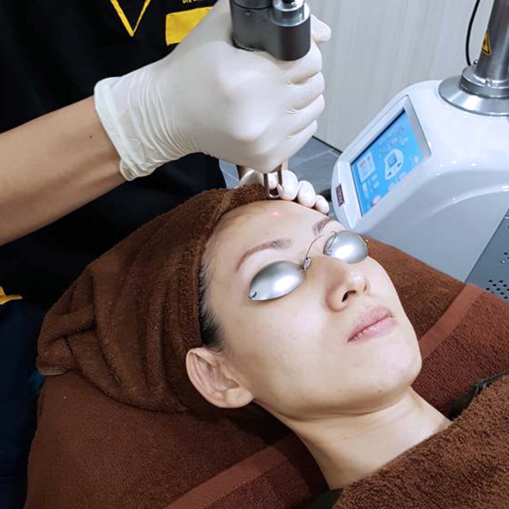 Revitalize Your Skin with CO2 Fractional Laser Treatments